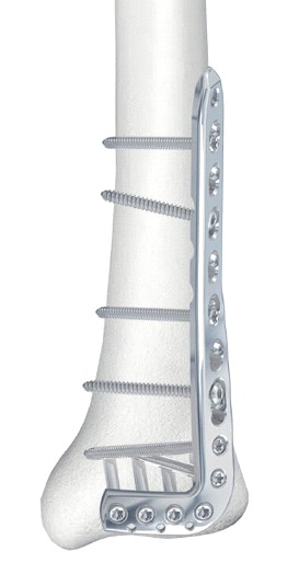 Implants for Distal Femur and Tibia – Bions Medical Systems